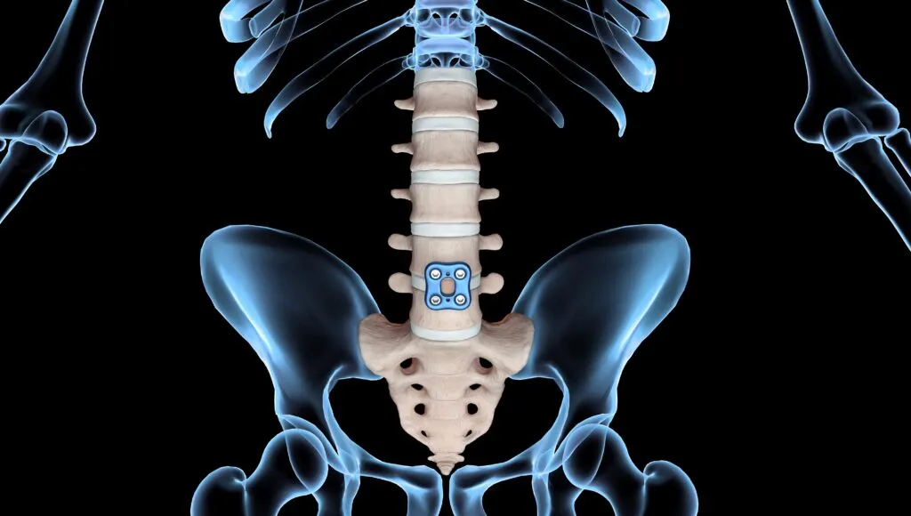 Biomechanical Testing of Spinal Implants: How Manufacturers Guarantee ...